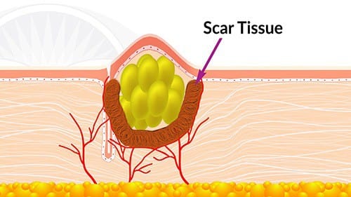 A Deep Dive into the Cause & Treatment of Acne & Acne Scarring - AMA ...
