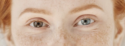 How to Remove Freckles: Different Treatments and Their Cost - AMA Regen ...