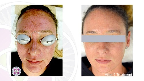 A Deep Dive into the Cause & Treatment of Melasma - AMA Regen Med ...