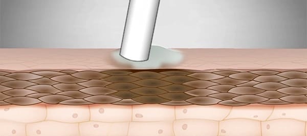 Acne Treatment with Lasers & Photodynamic Therapy (PDT) - AMA ...