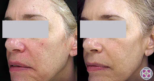 Rosacea Laser Treatment - AMA Regen Med & Skincare