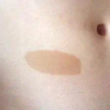 Can Laser Treatment Remove My Birthmark?