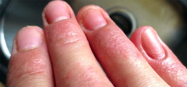Dermatitis: Symptoms, Causes and Treatment of the 7 Most Common Types