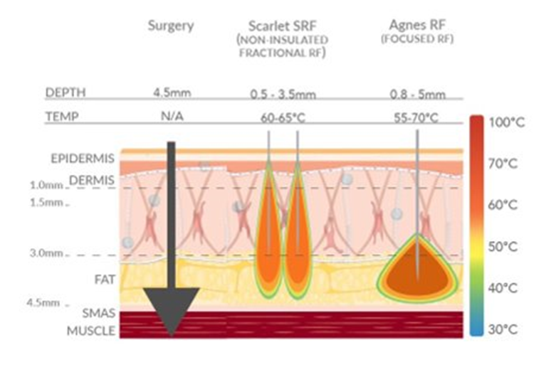 Agnes Radio Frequency Treatment | AMA Regen Med & Skincare