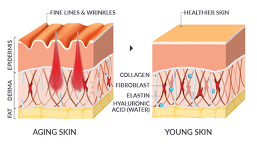 Scarlet SRF Microneedling - AMA Regen Med & Skincare